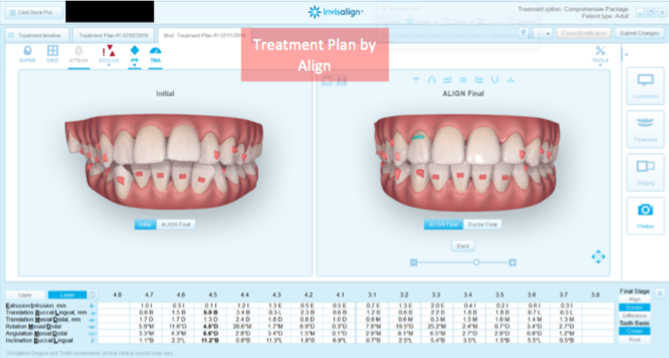 Correcting Midlines And Achieving Overbite | Aligner Concierge