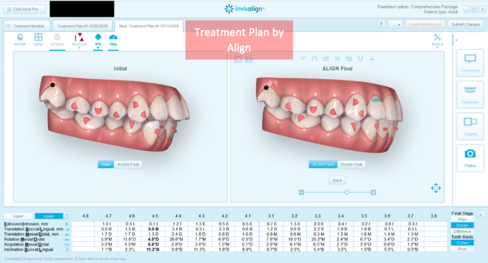 Correcting Midlines And Achieving Overbite | Aligner Concierge