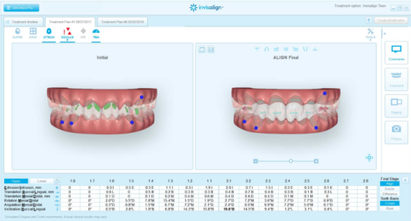 A standard approach of Treating Deep Bites using Aligners | Aligner ...