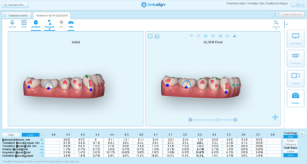 A standard approach of Treating Deep Bites using Aligners | Aligner ...