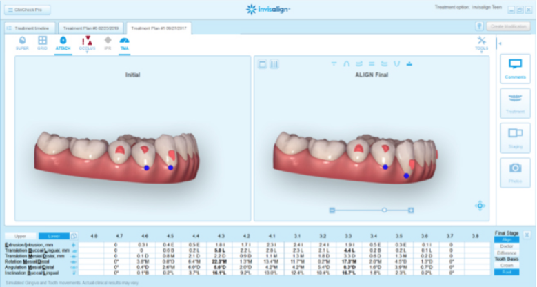 A standard approach of Treating Deep Bites using Aligners | Aligner ...
